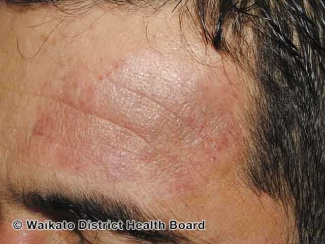 Cómo Saber si Tengo Dermatosis: Identifica los Síntomas y Entiende las ...