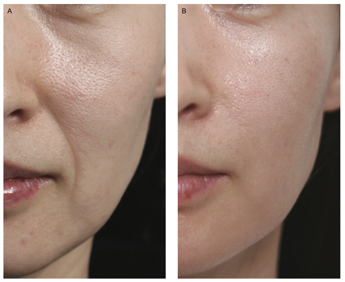 10 Beneficios de usar Ellanse