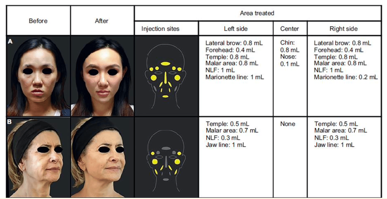 10 Beneficios de usar Ellanse