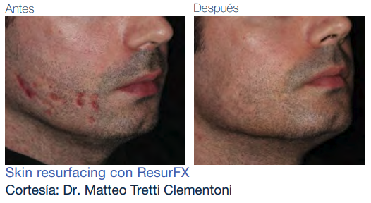 ¿Cuáles son las ventajas al usar láser + IPL para hiperpigmentación?